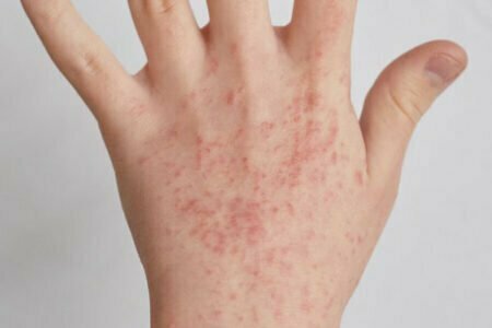 Common Chronic Skin Conditions